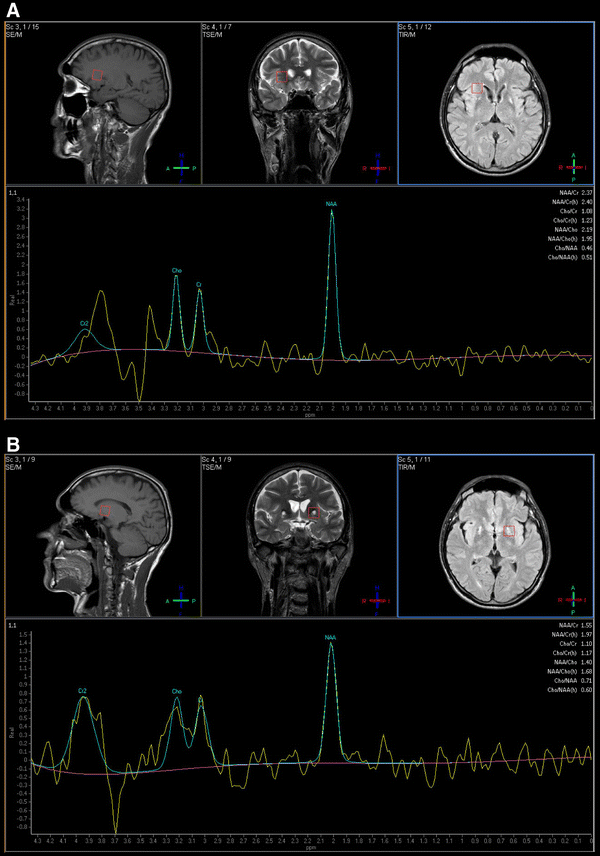 MR image mimicking the “eye of the tiger” sign in Wilson’s disease ...