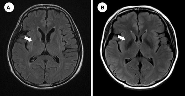 Diagnosis and differential diagnosis of MSA: boundary issues | SpringerLink