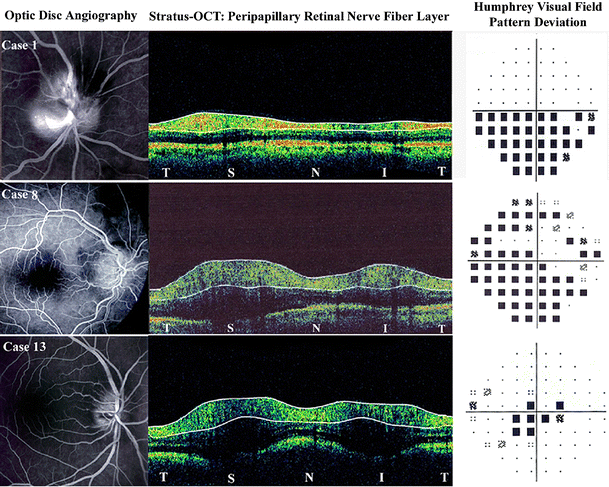 Retinal nerve fiber layer thickness in nonarteritic anterior ischemic ...