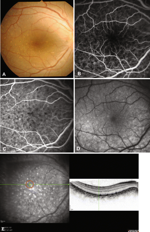 Fundus autofluorescence and spectral-domain optical coherence ...