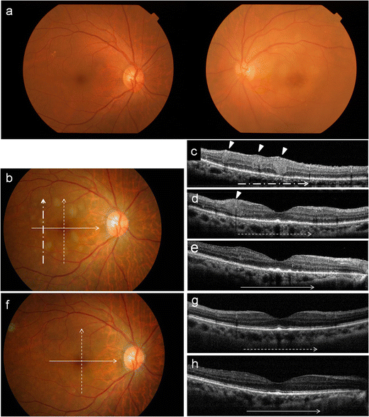 Optical coherence tomography manifestations of primary vitreoretinal ...