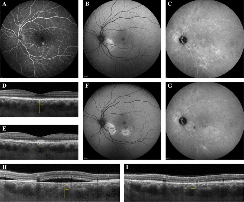 Photodynamic therapy in chronic central serous chorioretinopathy with ...