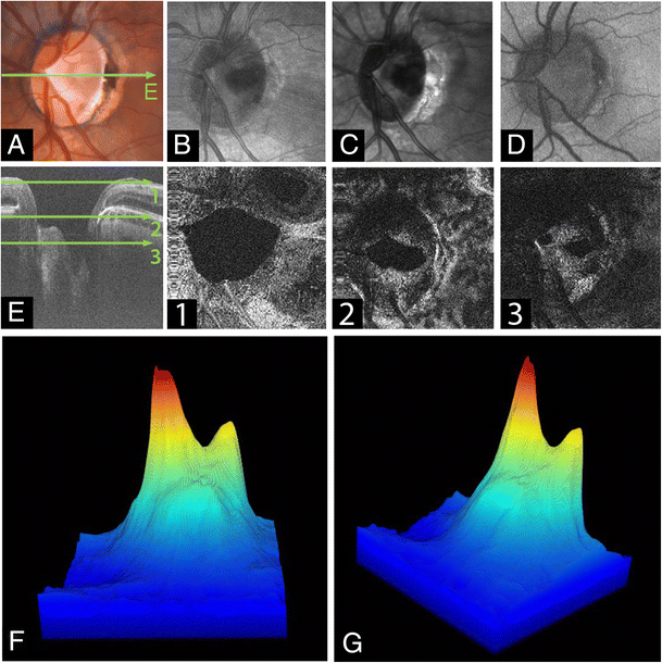 Combined in-depth, 3D, en face imaging of the optic disc, optic disc ...