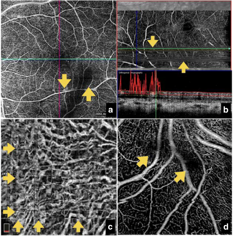 The role of OCT-A in retinal disease management | SpringerLink