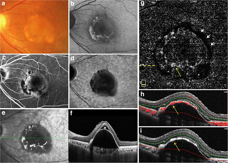 Retinal pigment epithelium hyperplasia overlying pigment epithelial ...