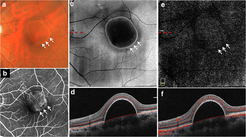 Retinal pigment epithelium hyperplasia overlying pigment epithelial ...