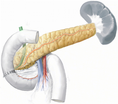 Duodenum-preserving total pancreatic head resection for cystic neoplasm ...