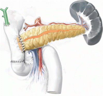 Duodenum-preserving total pancreatic head resection for cystic neoplasm ...