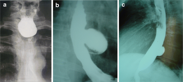 Modern pathophysiology and treatment of esophageal diverticula ...