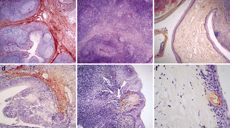 Immunohistochemical study of stromal and vascular components of ...