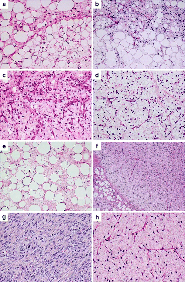 Extensive lipoma-like changes of myxoid liposarcoma: morphologic ...