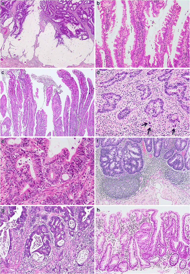 Distinct histopathological characteristics in colorectal submucosal ...