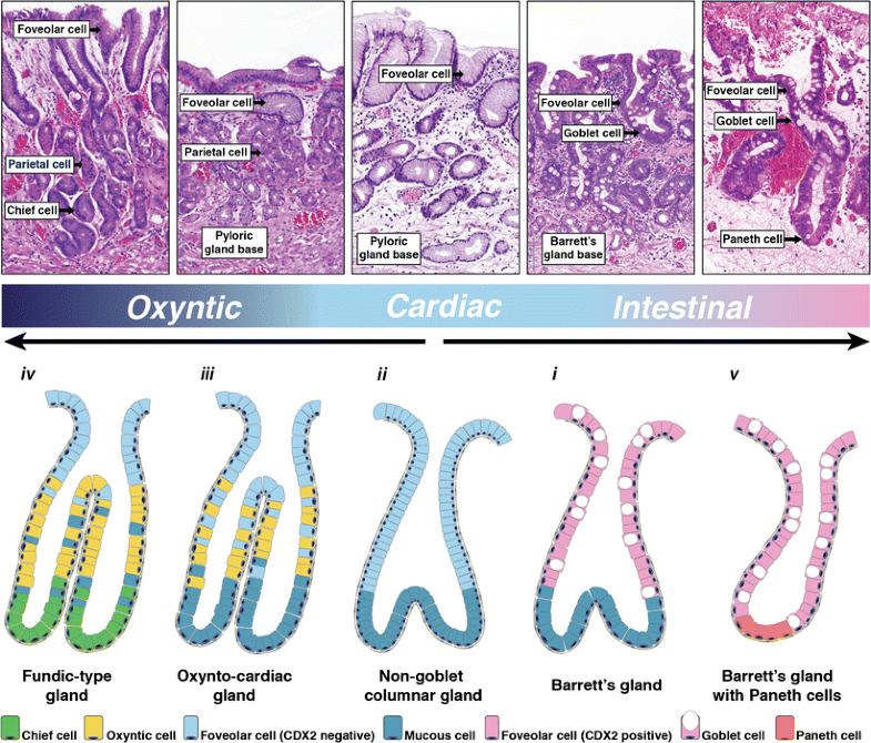 The metaplastic mosaic of Barrett’s oesophagus | SpringerLink