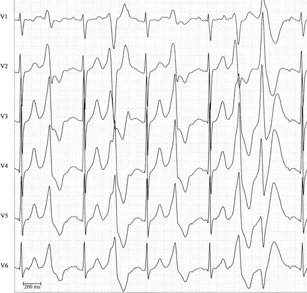 Catecholaminergic polymorphic ventricular tachycardia | SpringerLink
