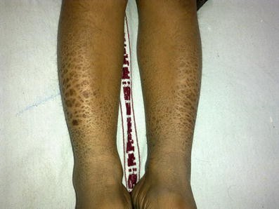 Steroid-resistant nephrotic syndrome associated with steroid sulfatase ...