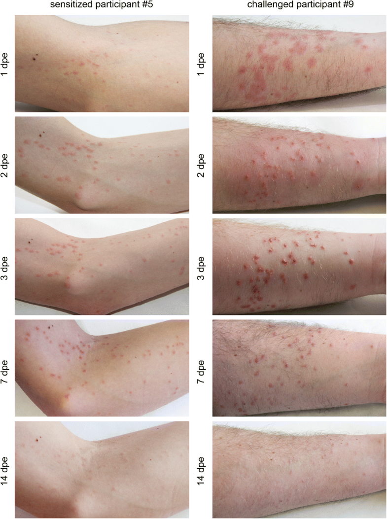 Cercarial dermatitis: a systematic follow-up study of human cases with ...