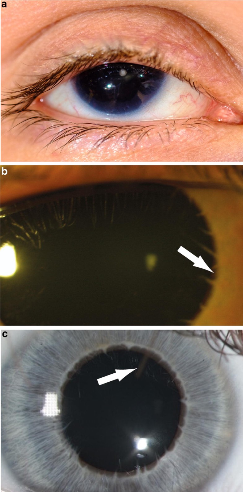 The genetic architecture of aniridia and Gillespie syndrome | SpringerLink
