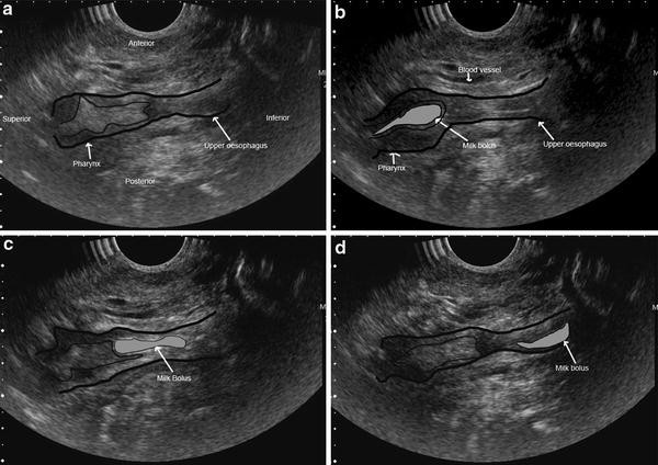 Ultrasound Imaging of Infant Swallowing During Breast-Feeding ...
