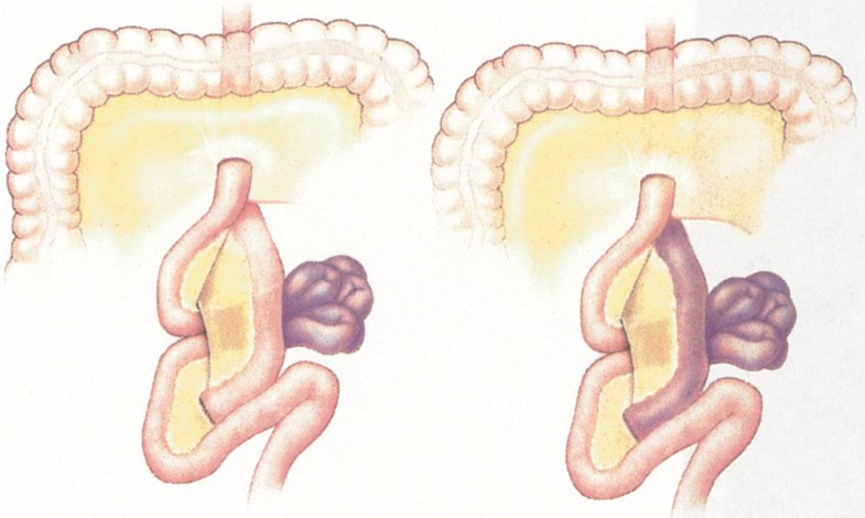 Symptomatic internal hernias after laparoscopic bariatric surgery ...