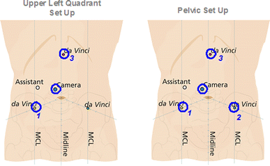 Totally robotic low anterior resection with total mesorectal excision ...