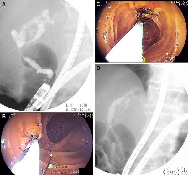 Long- and short-type double-balloon enteroscopy-assisted therapeutic ...