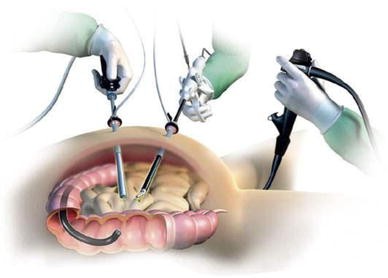 Combined endoscopic and laparoscopic surgery may be an alternative to ...