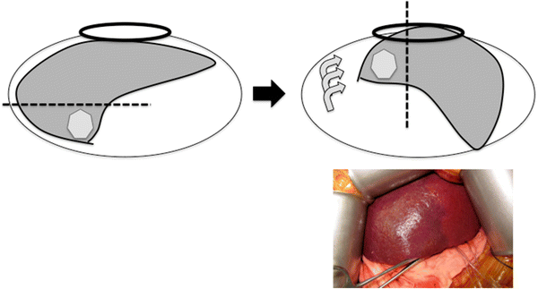 A hybrid method of laparoscopic-assisted open liver resection through a ...