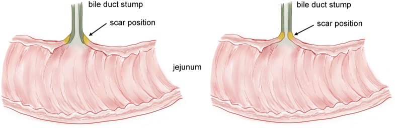 Laparoscopic-assisted cyst excision and ductoplasty plus widened ...