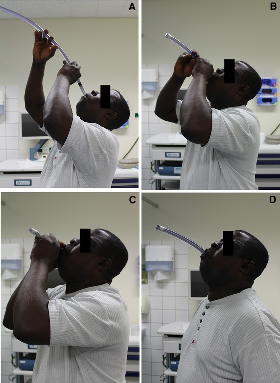 Self-dilation for therapy-resistant benign esophageal strictures ...