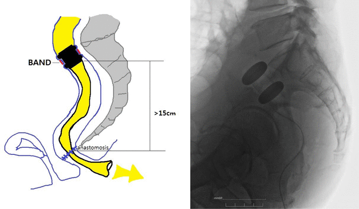 Fecal diverting device for the substitution of defunctioning stoma ...