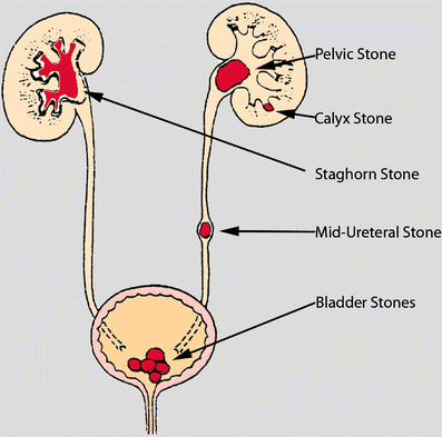 Physiopathology and etiology of stone formation in the kidney and the ...