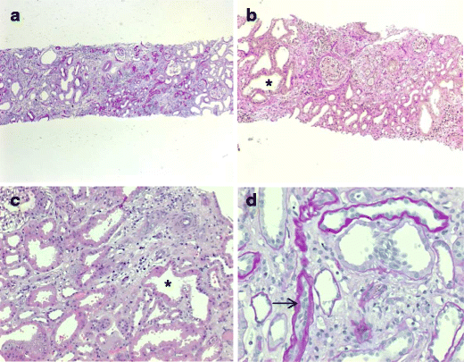 ARPKD and early manifestations of ADPKD: the original polycystic kidney ...