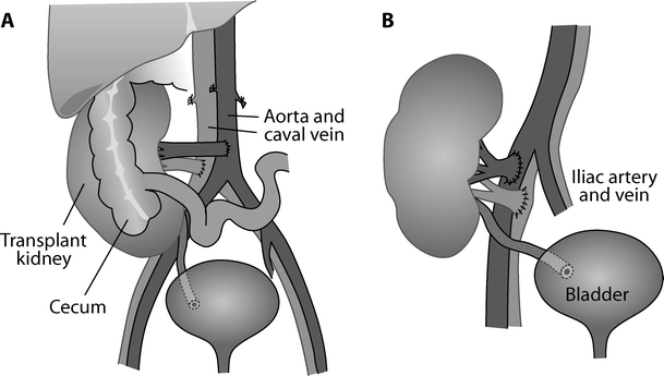 Renal transplantation in infants | SpringerLink