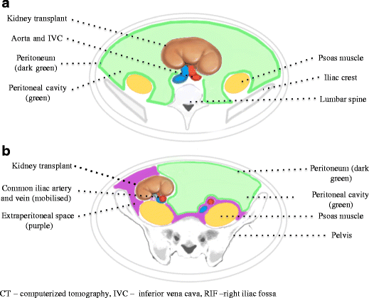 Graft nephrectomy in children | SpringerLink