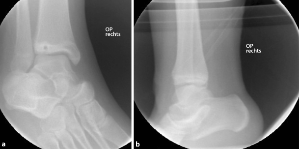 Displaced juvenile Tillaux fractures | SpringerLink