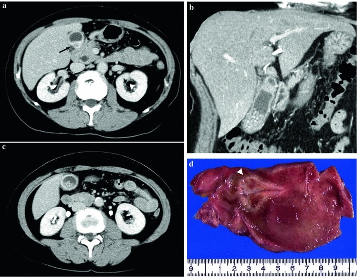 TG13 current terminology, etiology, and epidemiology of acute ...