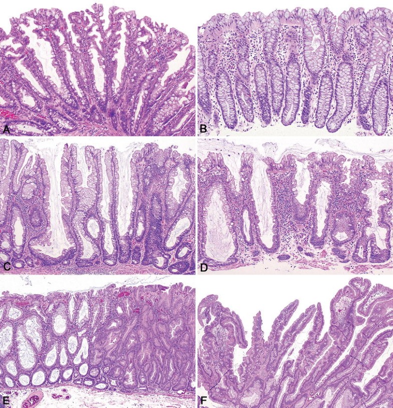Serrated polyps of the large intestine: current understanding of ...