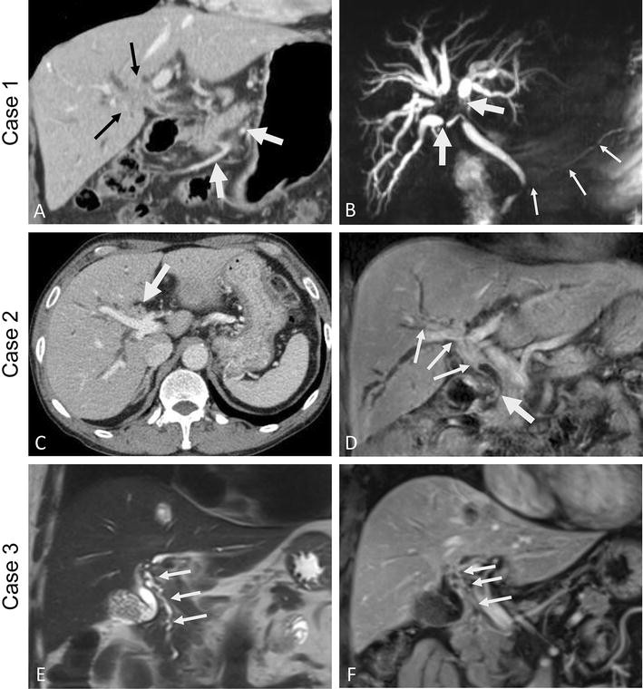IgG4-related sclerosing cholangitis: all we need to know | SpringerLink
