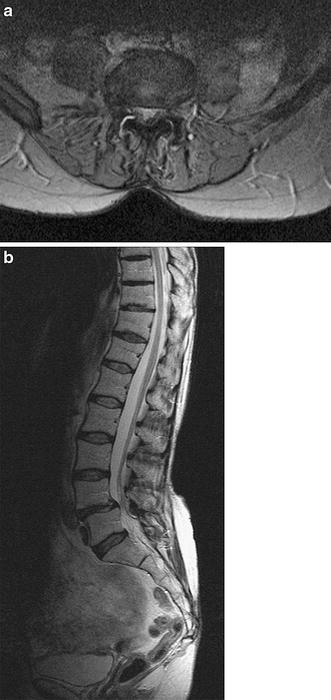 High failure rate of the interspinous distraction device (X-Stop) for ...