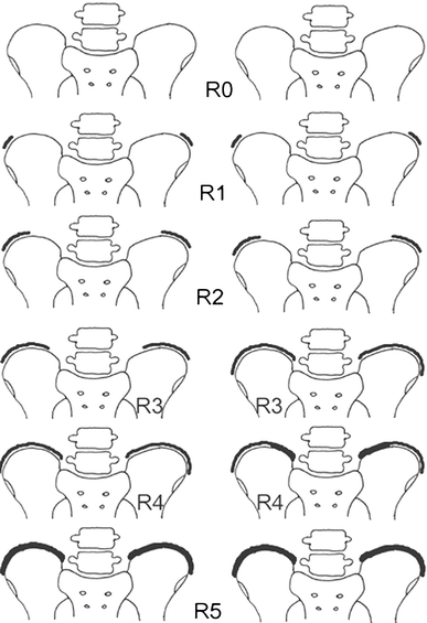 Improved accuracy in Risser sign grading with lateral spinal ...
