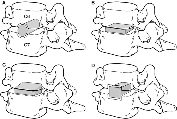 Bone graft substitutes in anterior cervical discectomy and fusion ...