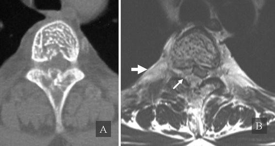 Aggressive Vertebral Hemangioma Of The Thoracic Spine Without Typical