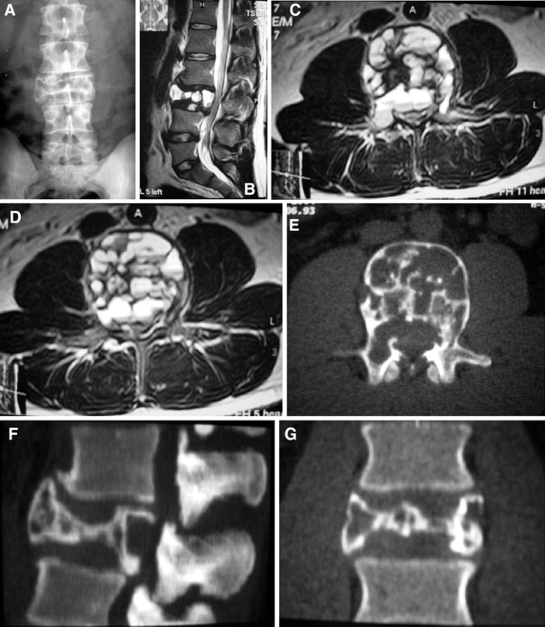 Aneurysmal bone cysts of the spine | SpringerLink