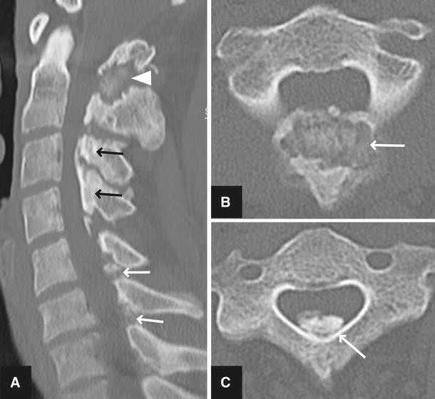 Multiple-level ossification of the ligamentum flavum in the cervical ...
