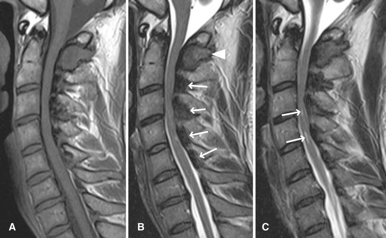 Multiple-level ossification of the ligamentum flavum in the cervical ...