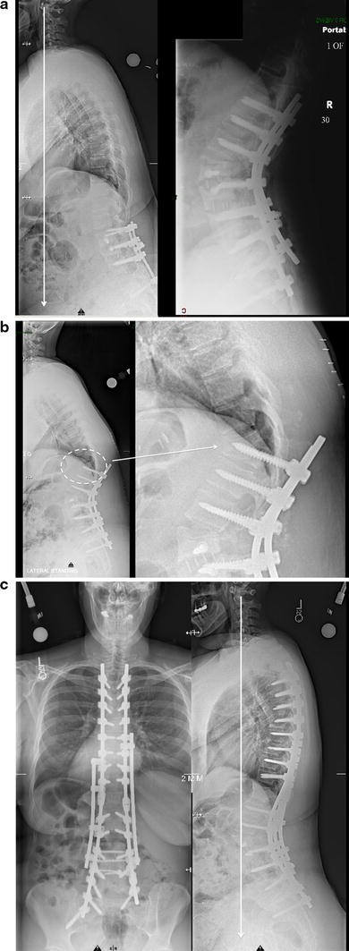 Junctional spinal disorders in operated adult spinal deformities ...
