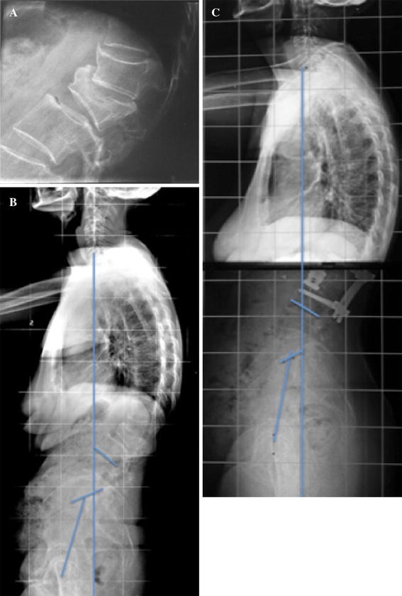Classification of sagittal imbalance based on spinal alignment and ...