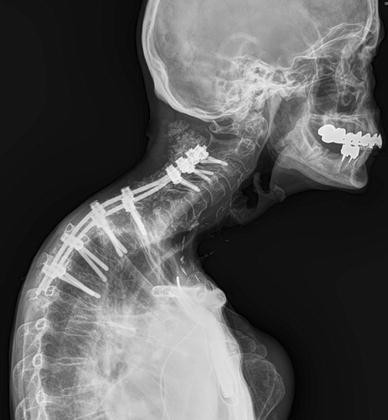 Pedicle subtraction osteotomy for the treatment of chin-on-chest ...