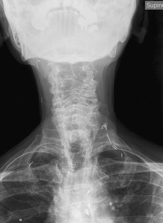 Pedicle subtraction osteotomy for the treatment of chin-on-chest ...