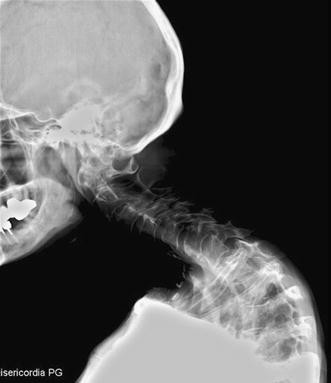 Pedicle subtraction osteotomy for the treatment of chin-on-chest ...